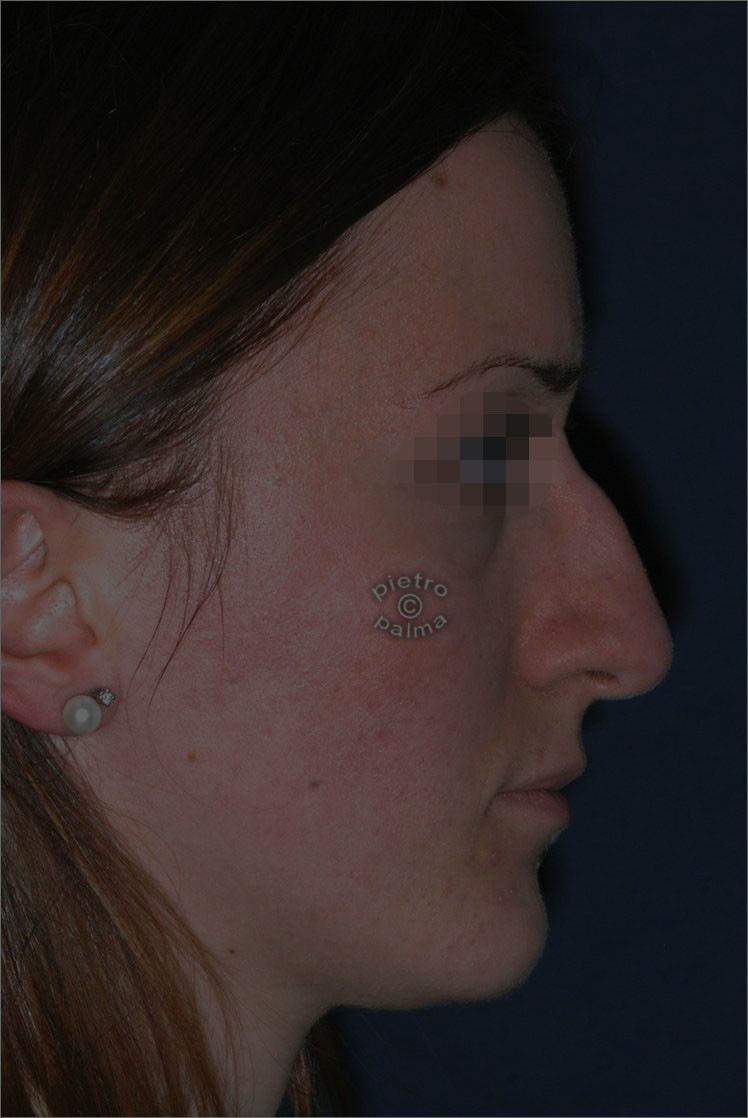 Rhinoplasty before and after 7 day - PIETRO PALMA