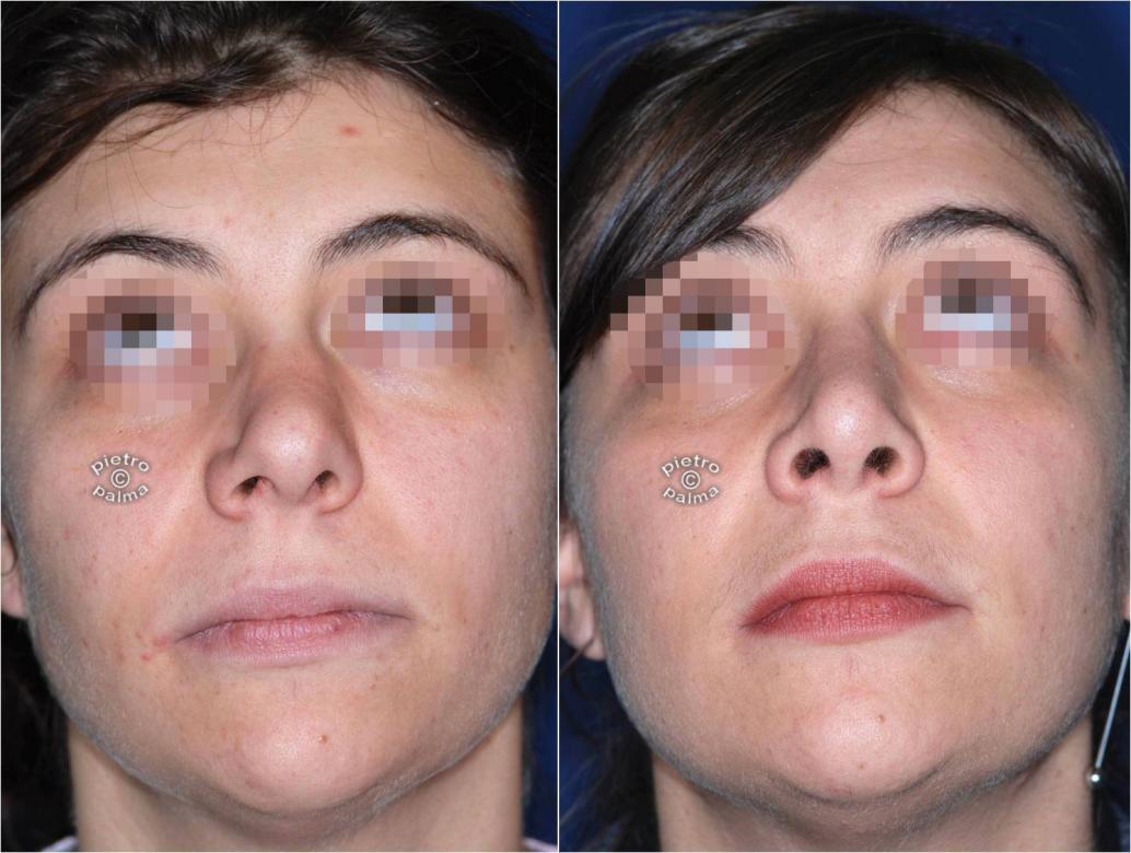 Deviated septum before and after surgery photo