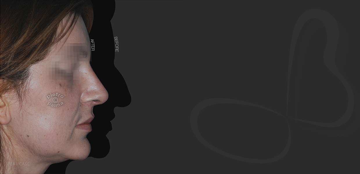 PIETRO PALMA – rhinoplasty surgeon in Milan. Nose job Italy